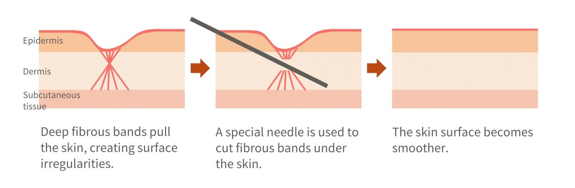 Subcision - BLAZE CLINIC【Medical Diet & Cosmetic Dermatology】