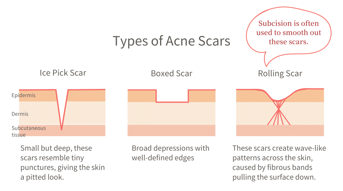 Subcision - BLAZE CLINIC【Medical Diet & Cosmetic Dermatology】